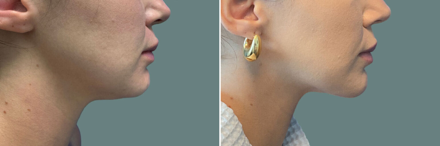 Different Types of Chin Implants: Which One is Right for You?